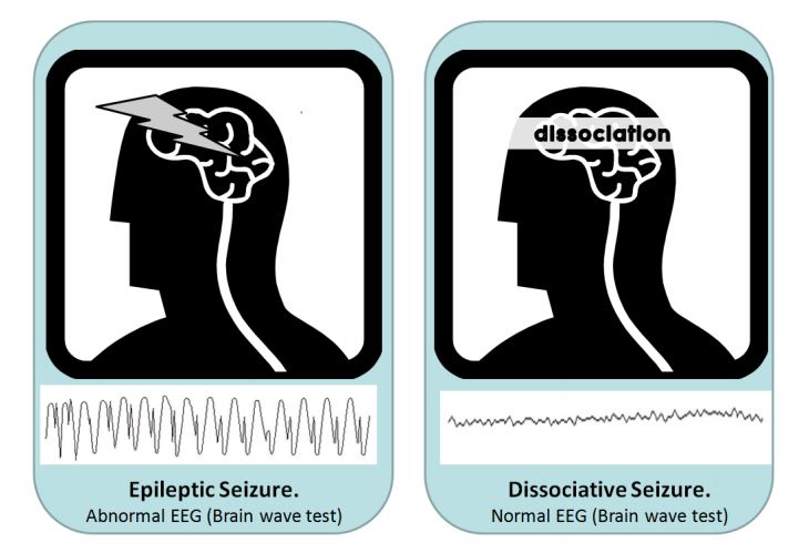 Functional (Dissociative) Seizures – Functional Neurological Disorder (FND)